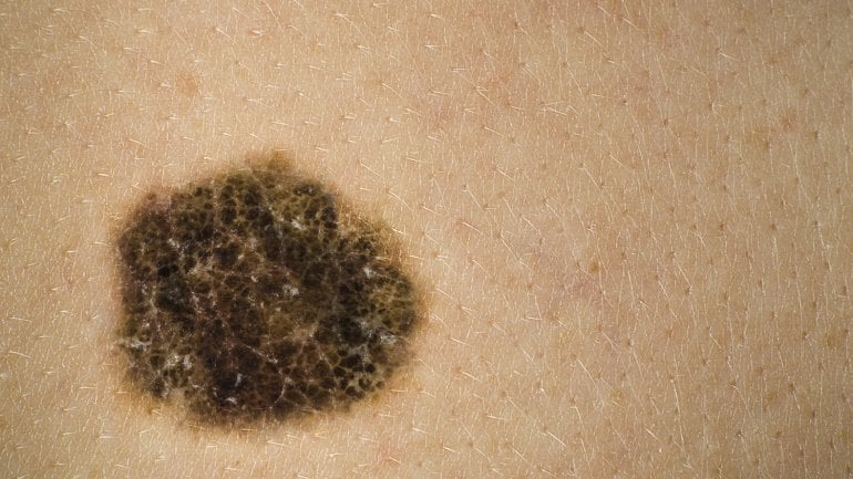 Hautkrebs-Bilder: Wie sieht Hautkrebs aus?