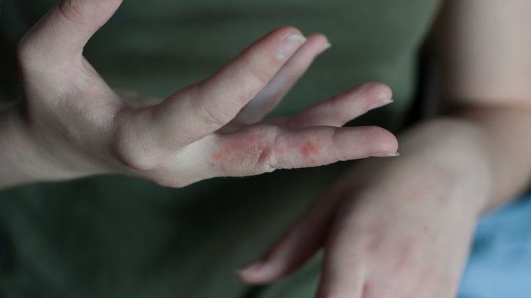 Krätze erkennen: Bilder und Symptome von Scabies