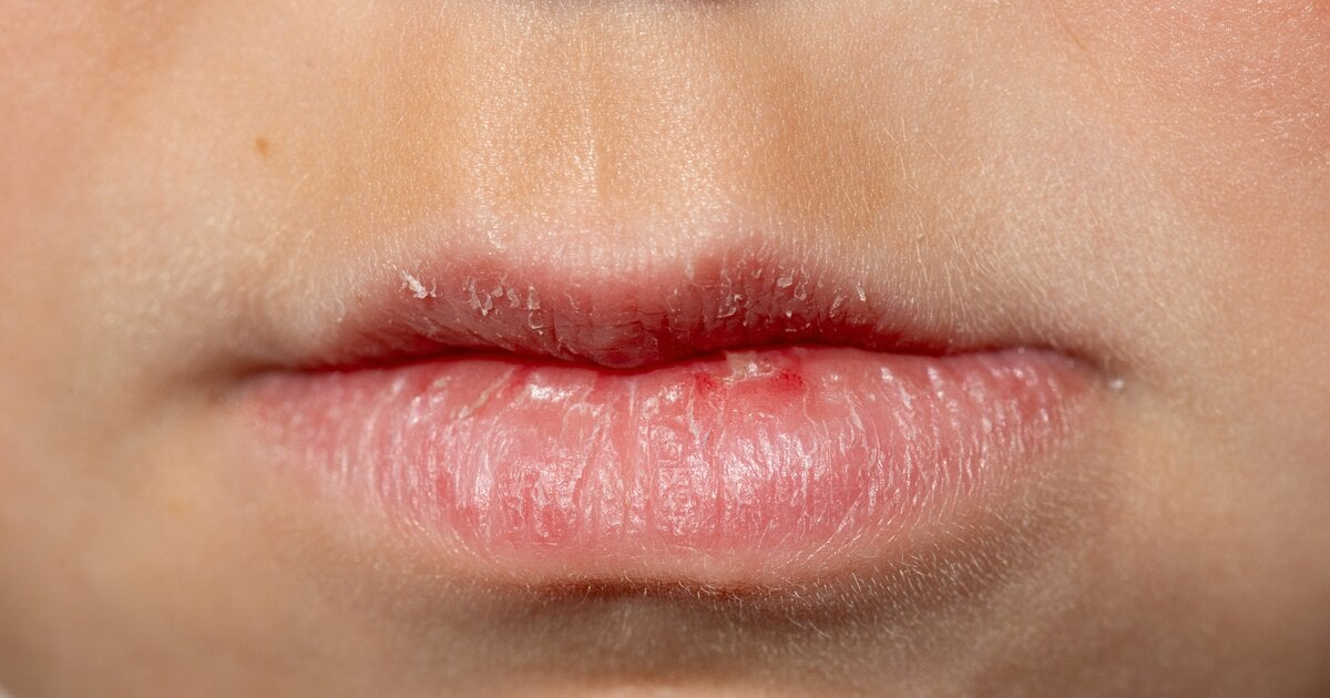 Trockene Lippen: 8 häufige Ursachen