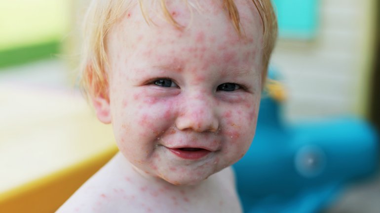 Wie sehen Windpocken aus? Bilder und Symptome