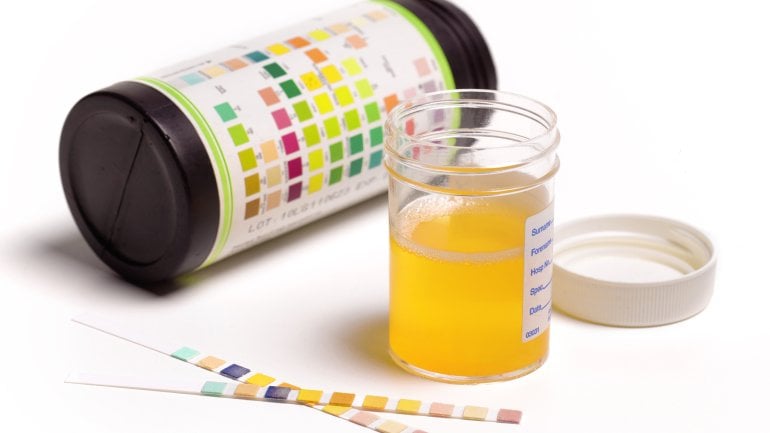 Urinwerte verstehen: Normwerte mit Tabelle